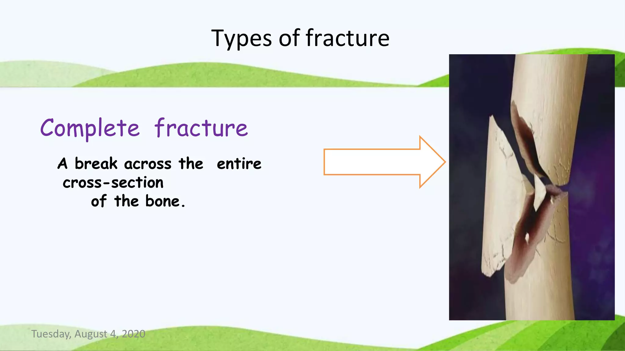 Fracture (Ayoub) | PPTX