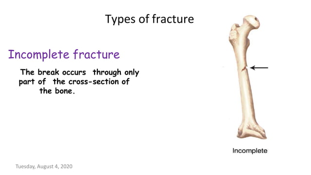 Fracture (Ayoub) | PPTX