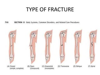 Fracture bed | PPTX