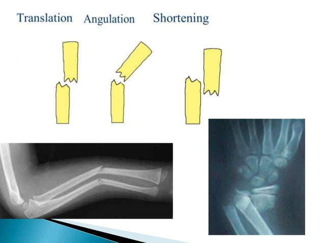 Fracture both bones leg class ug | PPTX