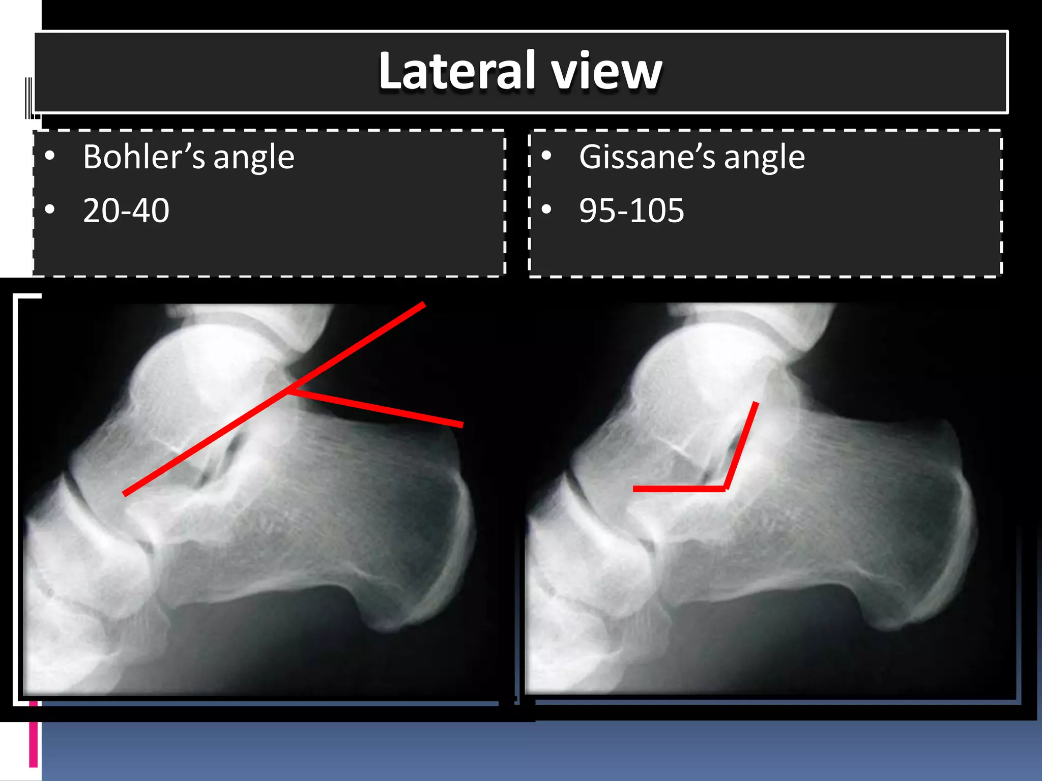 Fracture calcaneum and talus by dr ashutosh | PPTX
