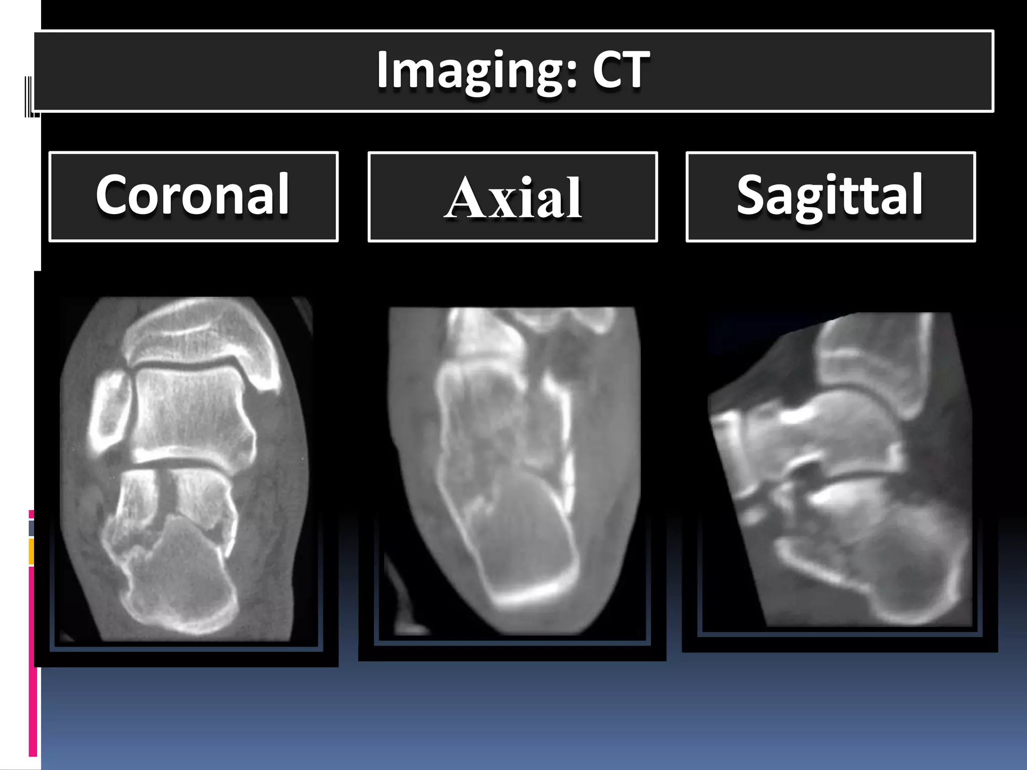 Fracture calcaneum and talus by dr ashutosh | PPTX