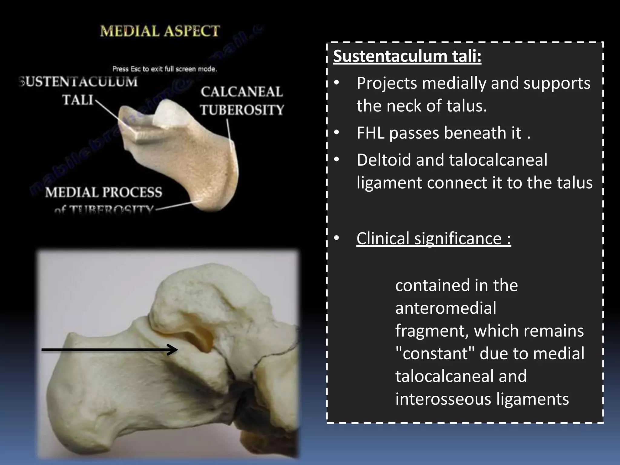 Fracture calcaneum and talus by dr ashutosh | PPTX