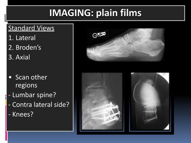 Fracture calcaneum and talus by dr ashutosh | PPTX