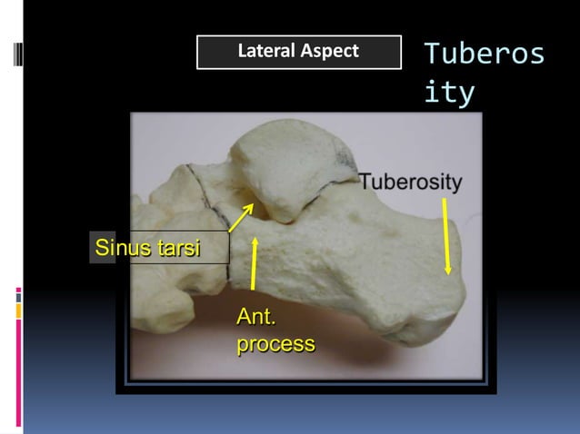 Fracture calcaneum and talus by dr ashutosh | PPTX
