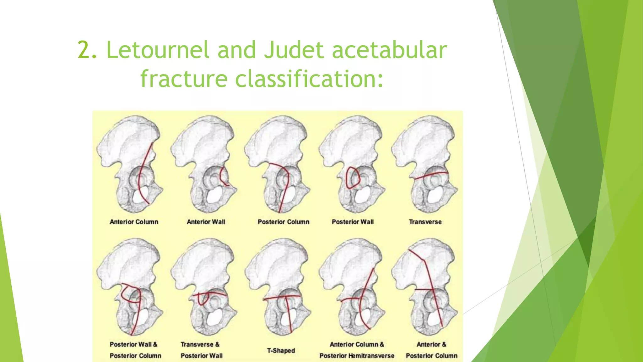 Fracture classification | PPTX