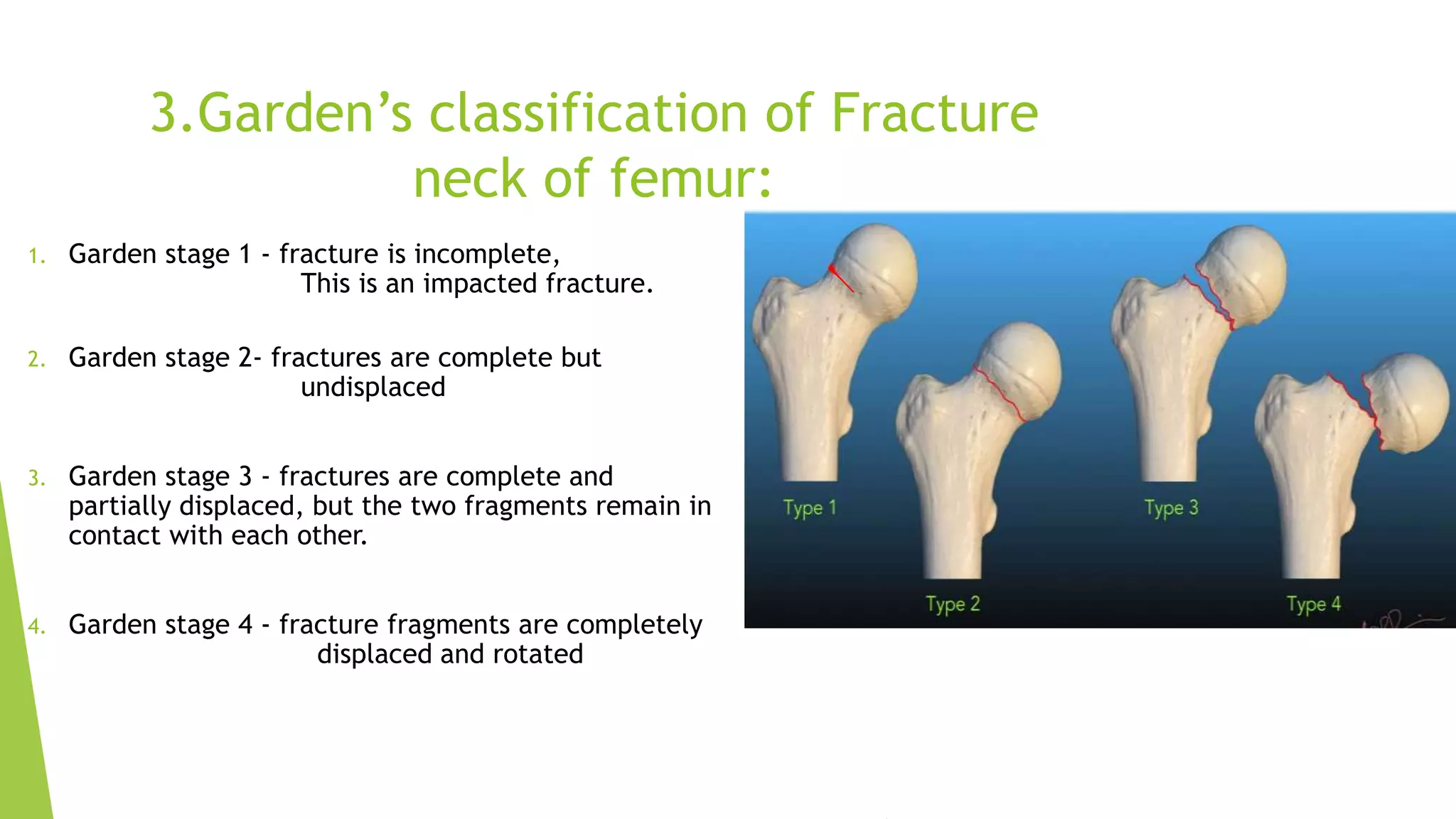 Fracture classification | PPTX