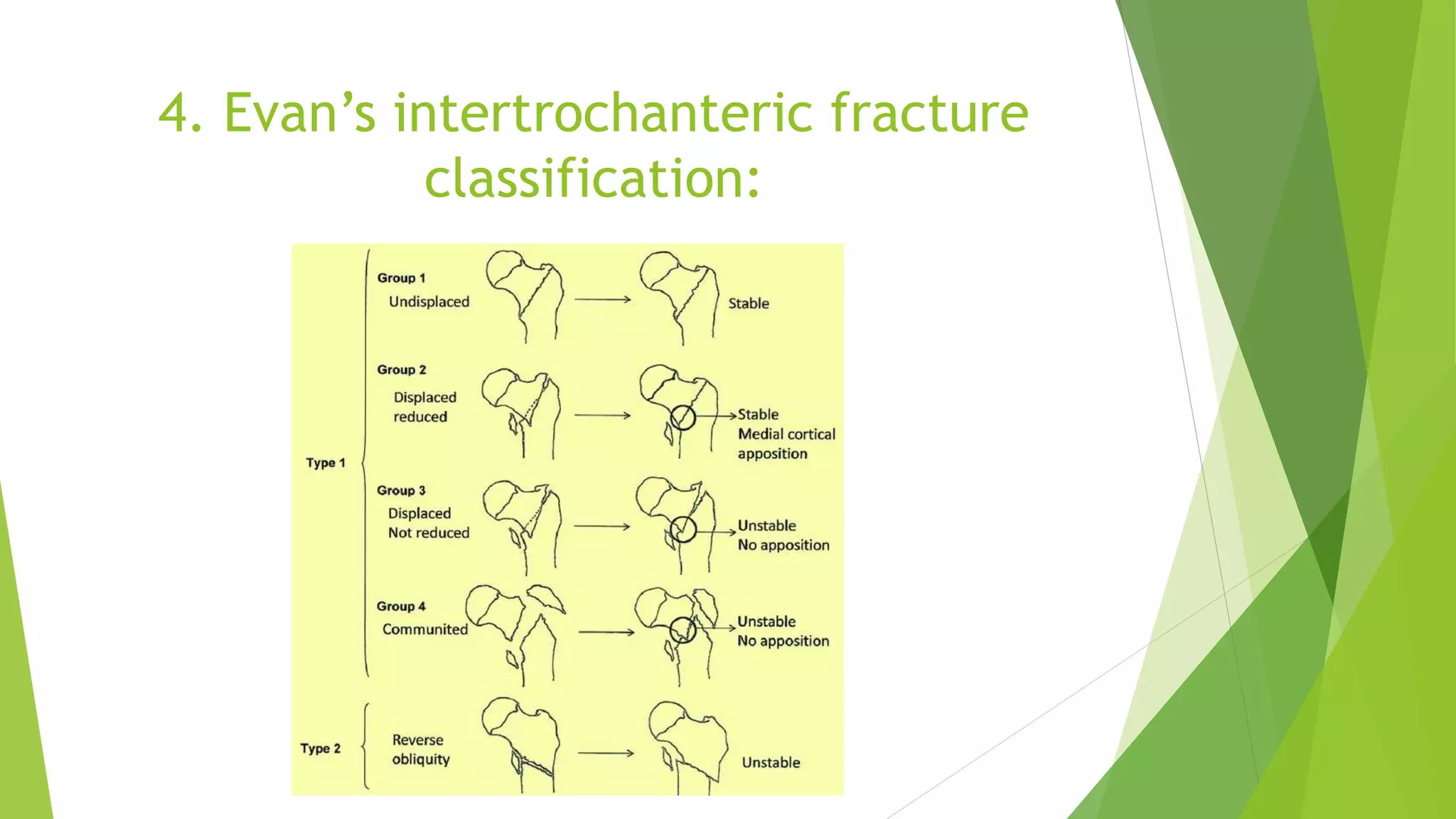 Fracture classification | PPTX
