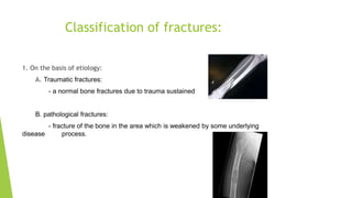 Fracture classification | PPTX