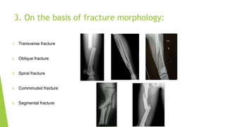 Fracture classification | PPTX