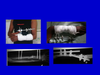 Fracture classification and General principles of management.ppt