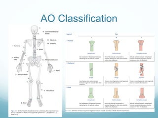 Fracture , classification and healing | PPTX