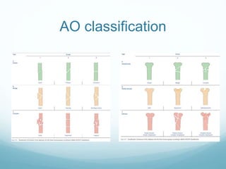 Fracture , classification and healing | PPTX | Death, Injury, or ...