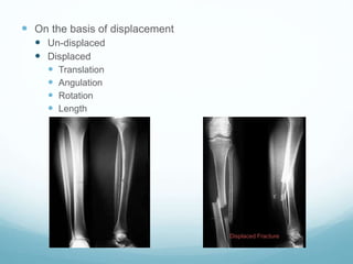 Fracture , classification and healing | PPTX | Death, Injury, or ...