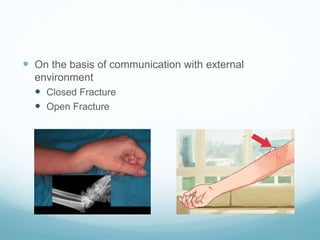 Fracture , classification and healing | PPTX