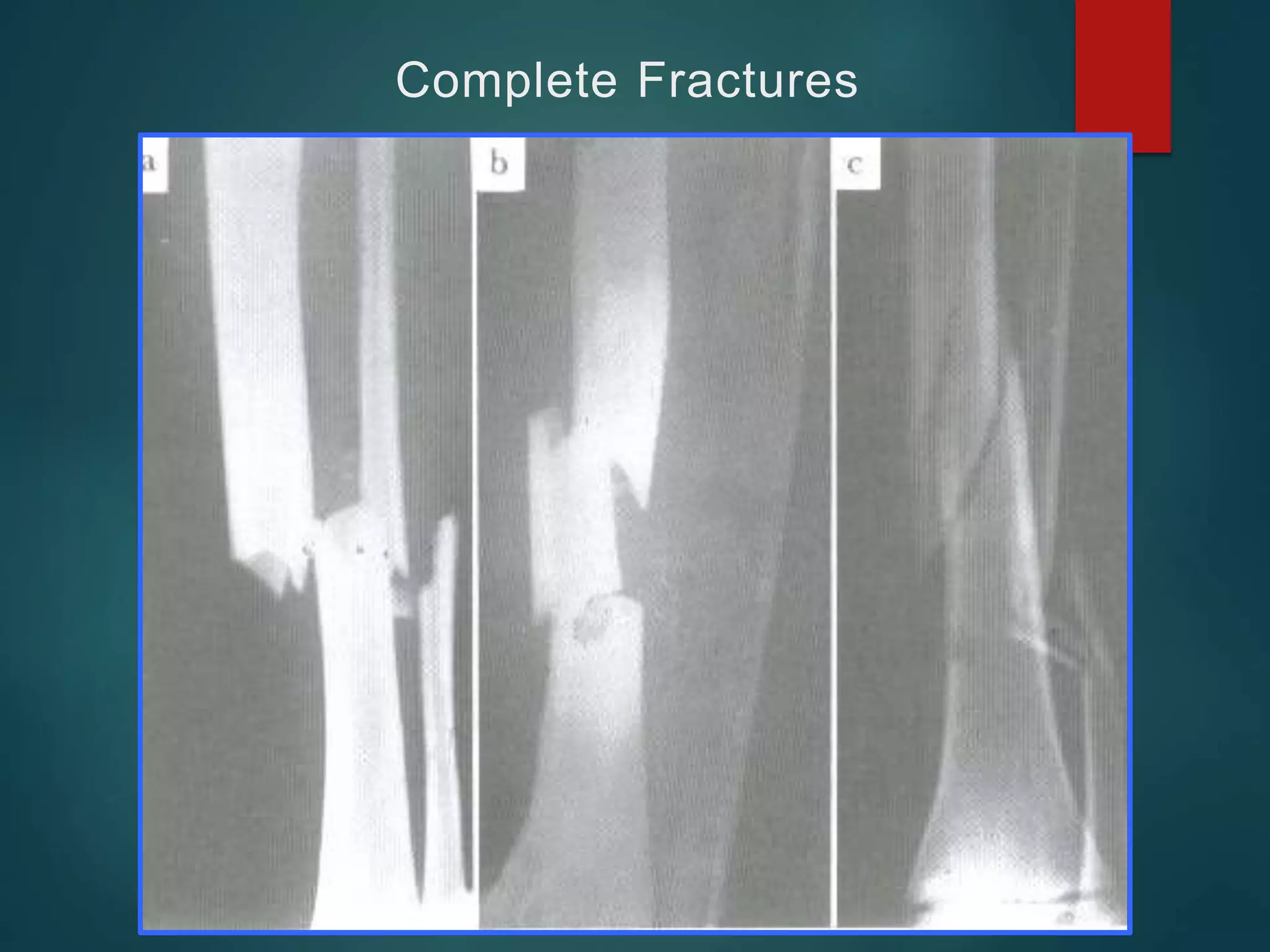 Fracture classification and Trauma introduction. | PPTX