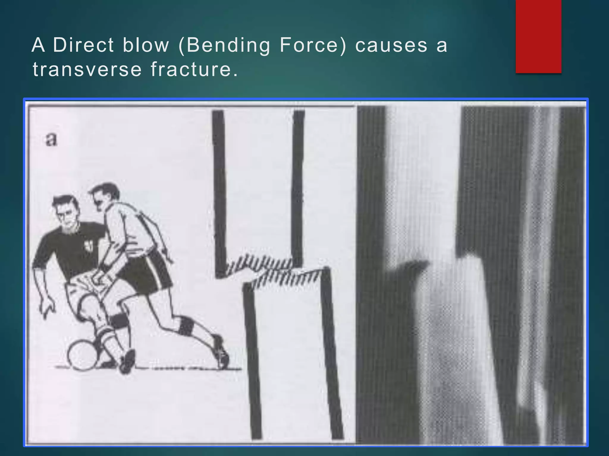 Fracture classification and Trauma introduction. | PPTX