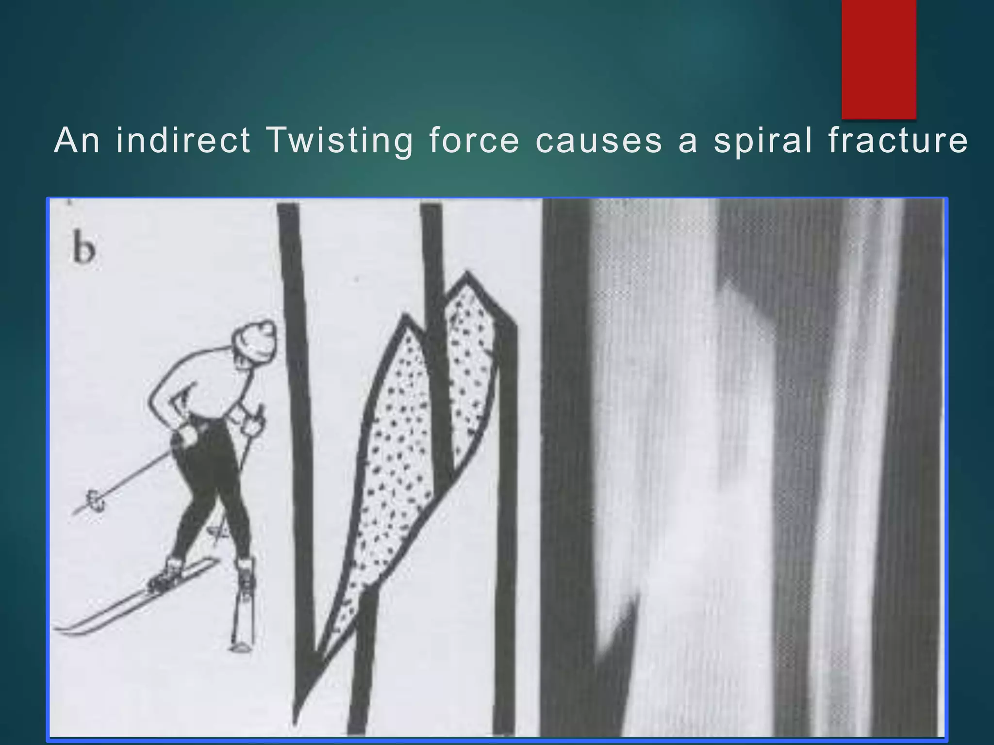 Fracture classification and Trauma introduction. | PPTX