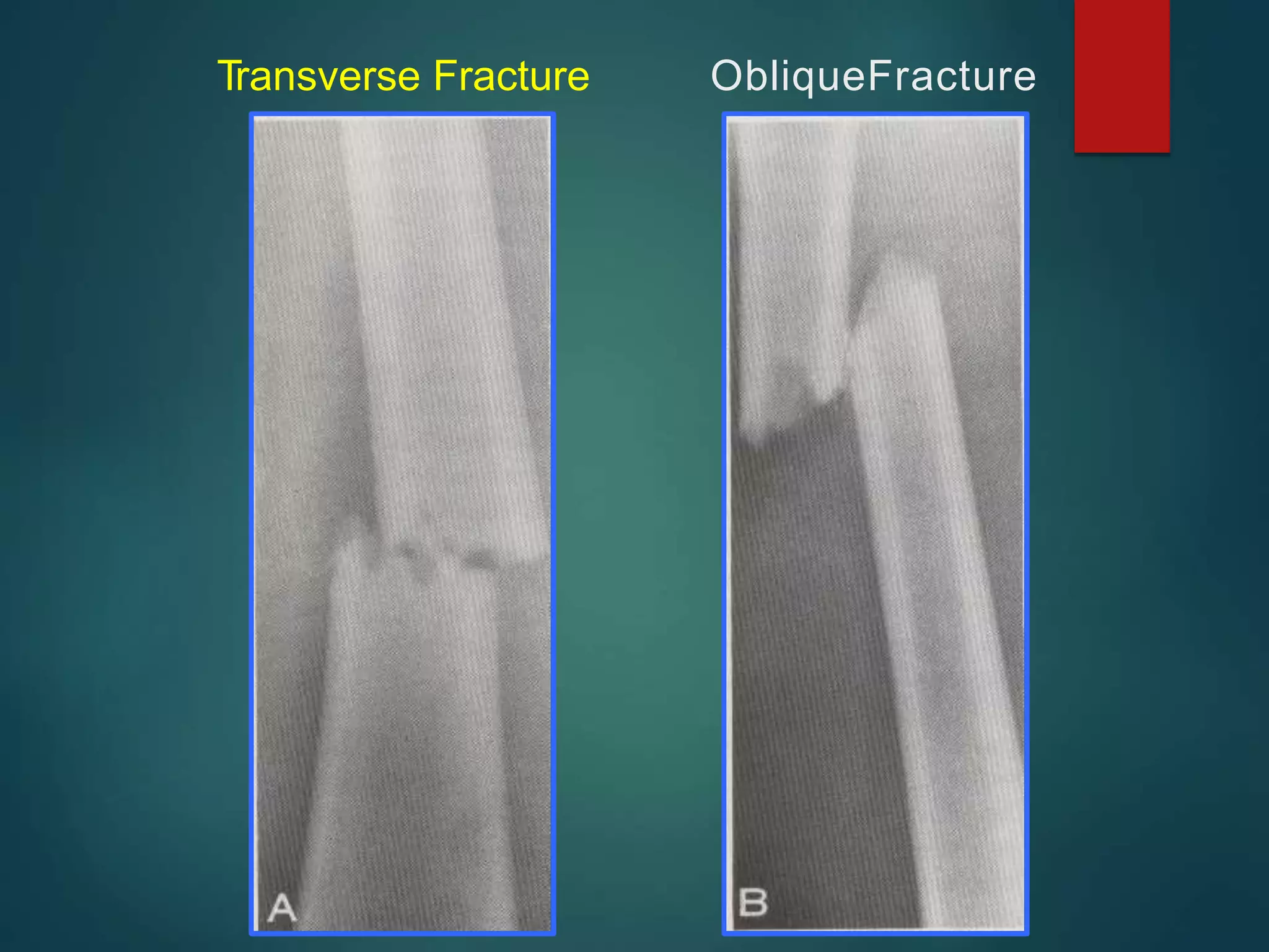 Fracture classification and Trauma introduction. | PPTX