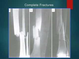 Fracture classification and Trauma introduction. | PPTX