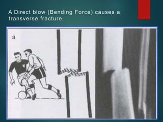 Fracture classification and Trauma introduction. | PPTX