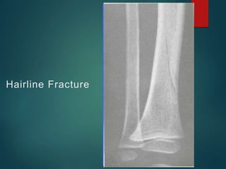 Fracture classification and Trauma introduction. | PPTX