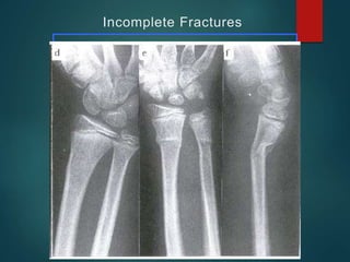 Fracture classification and Trauma introduction. | PPTX