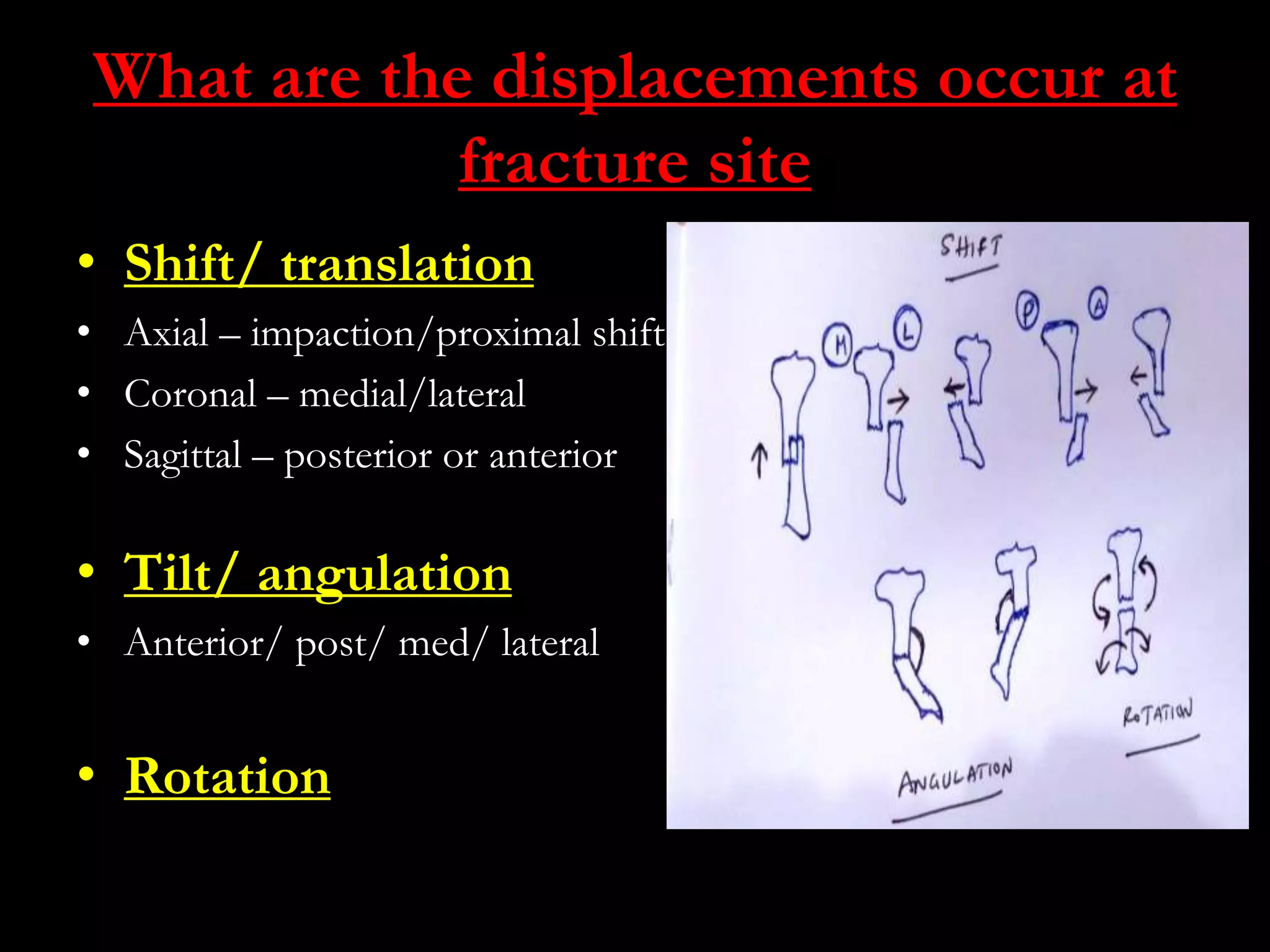 Fracture classification, healing | PPTX