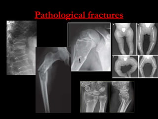 Fracture classification, healing | PPTX