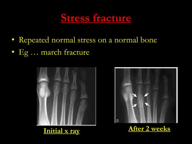 Fracture classification, healing | PPTX