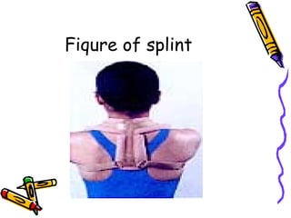 Fracture Clavicle | PPT