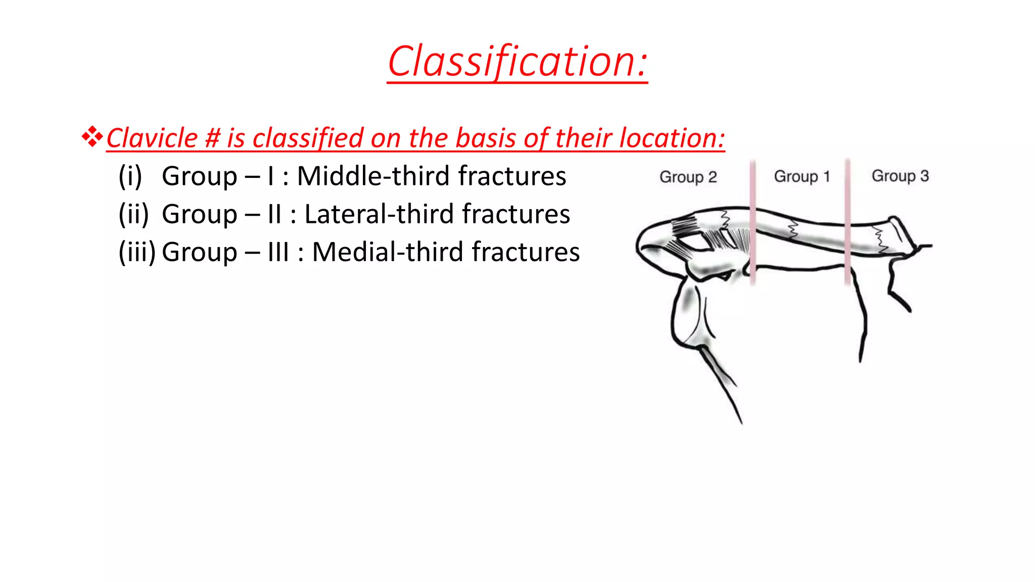 Fracture clavicle | PPTX