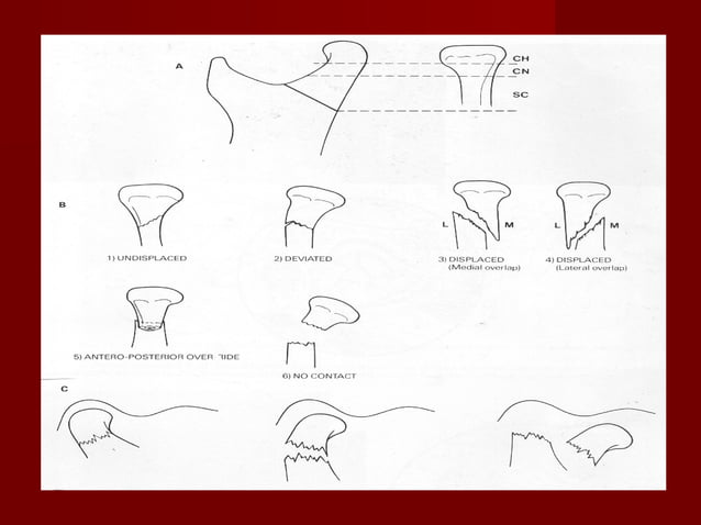 Fracture condyle | PPT