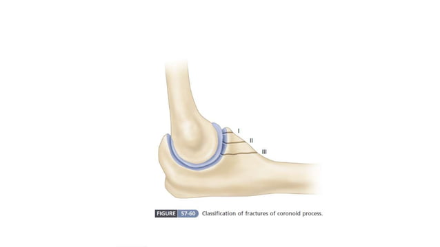 Fracture coronoid process of ulna | PPTX
