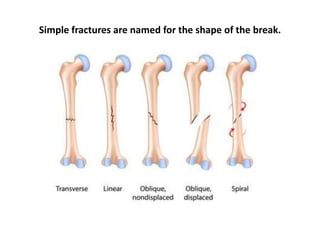 Fractured bones | PPTX