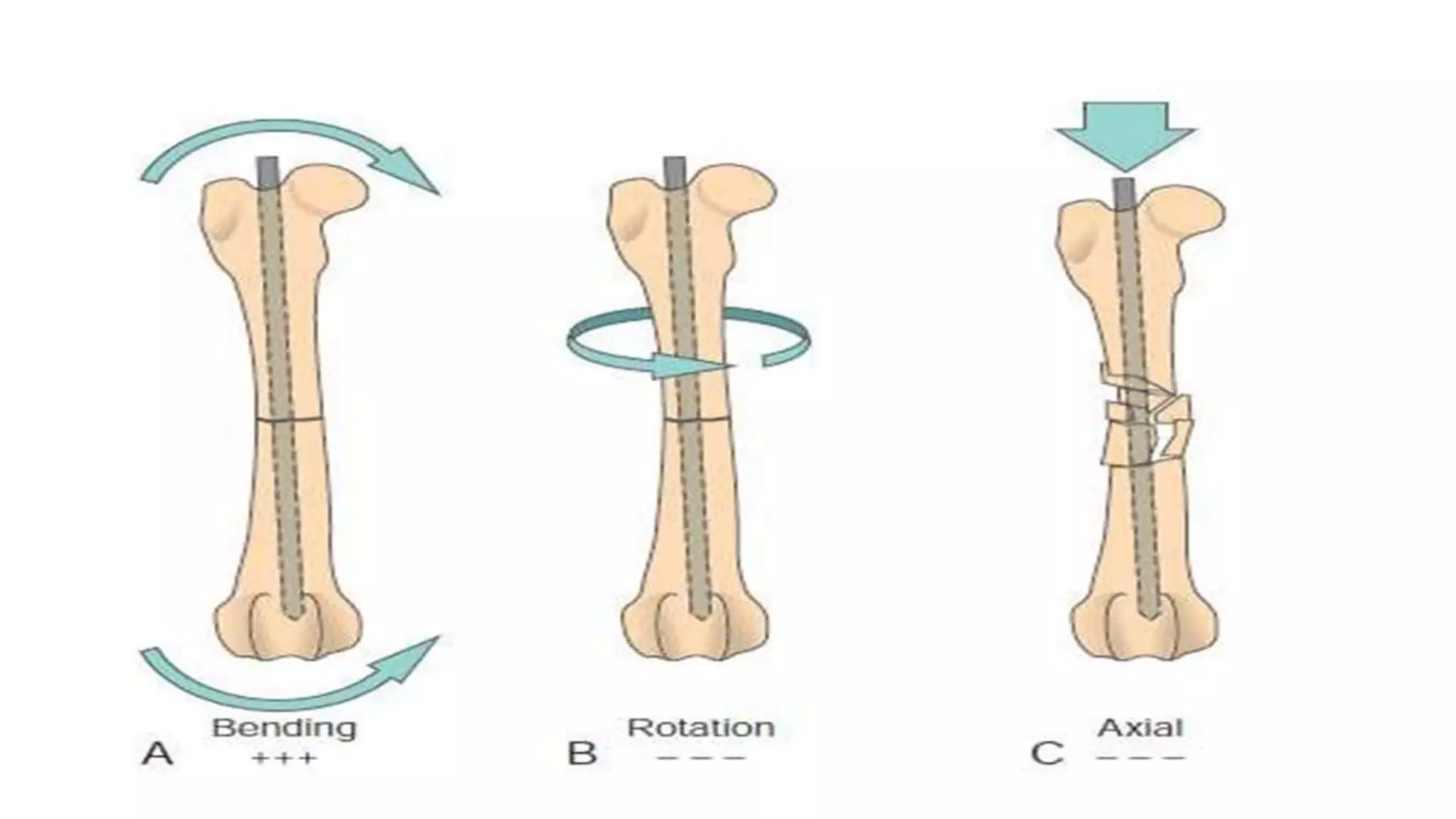 Fracture Fixation Techniques.pptx