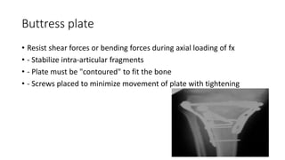 Fracture Fixation Techniques.pptx