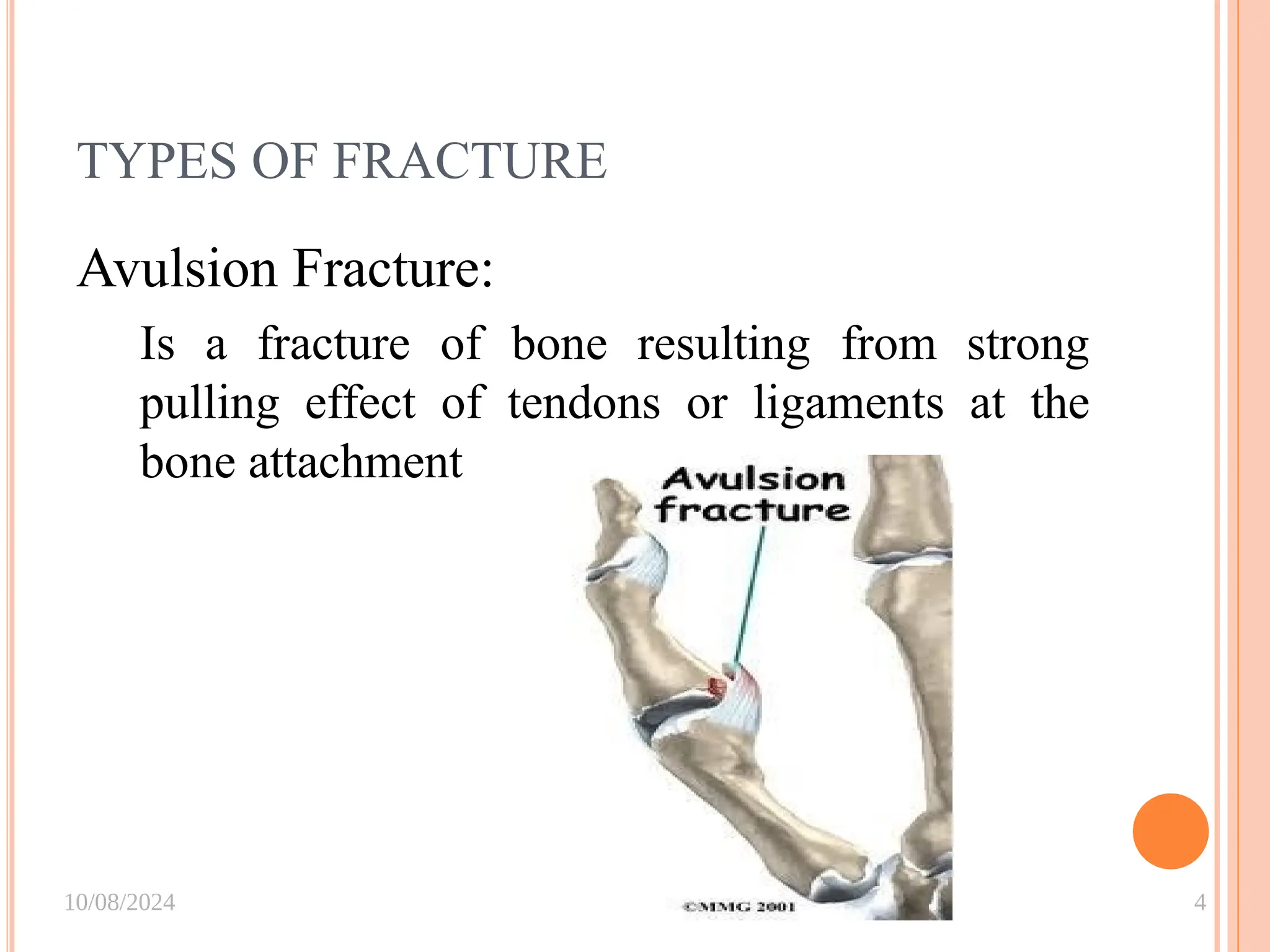 fracture for Emergency and Critical Care Nursing students.pptx
