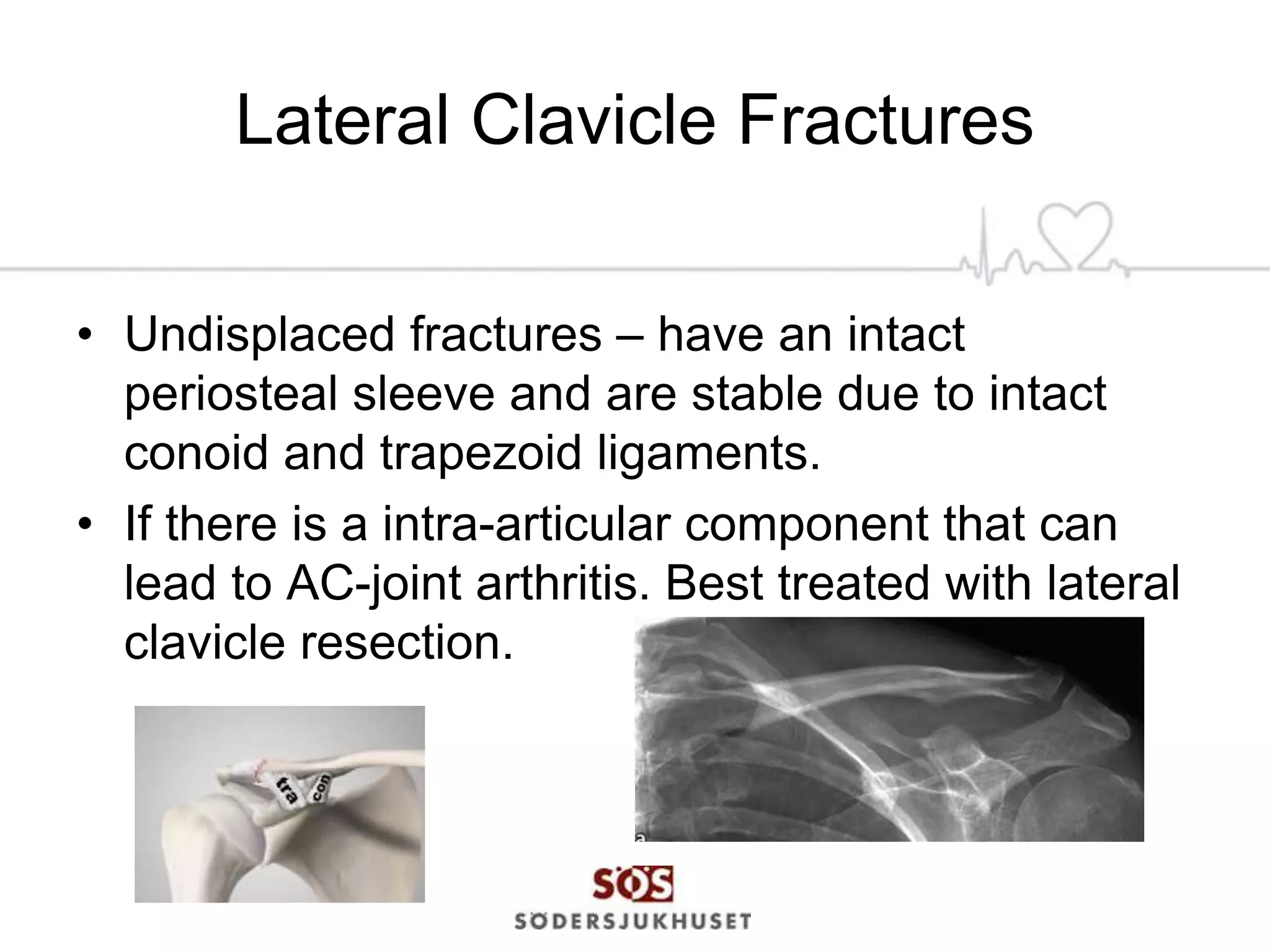 Clavicle Fractures - A review | PPTX