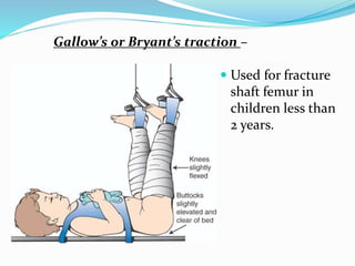 FRACTURE – GENERAL MANAGEMENT AND COMPLICATIONS.pptx