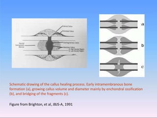 Fracture healing | PPT