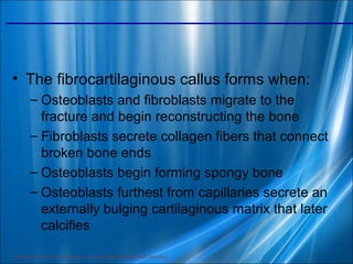 Fracture healing | PPT