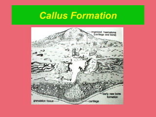 Fracture healing | PPT