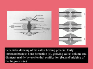 Fracture healing | PPT