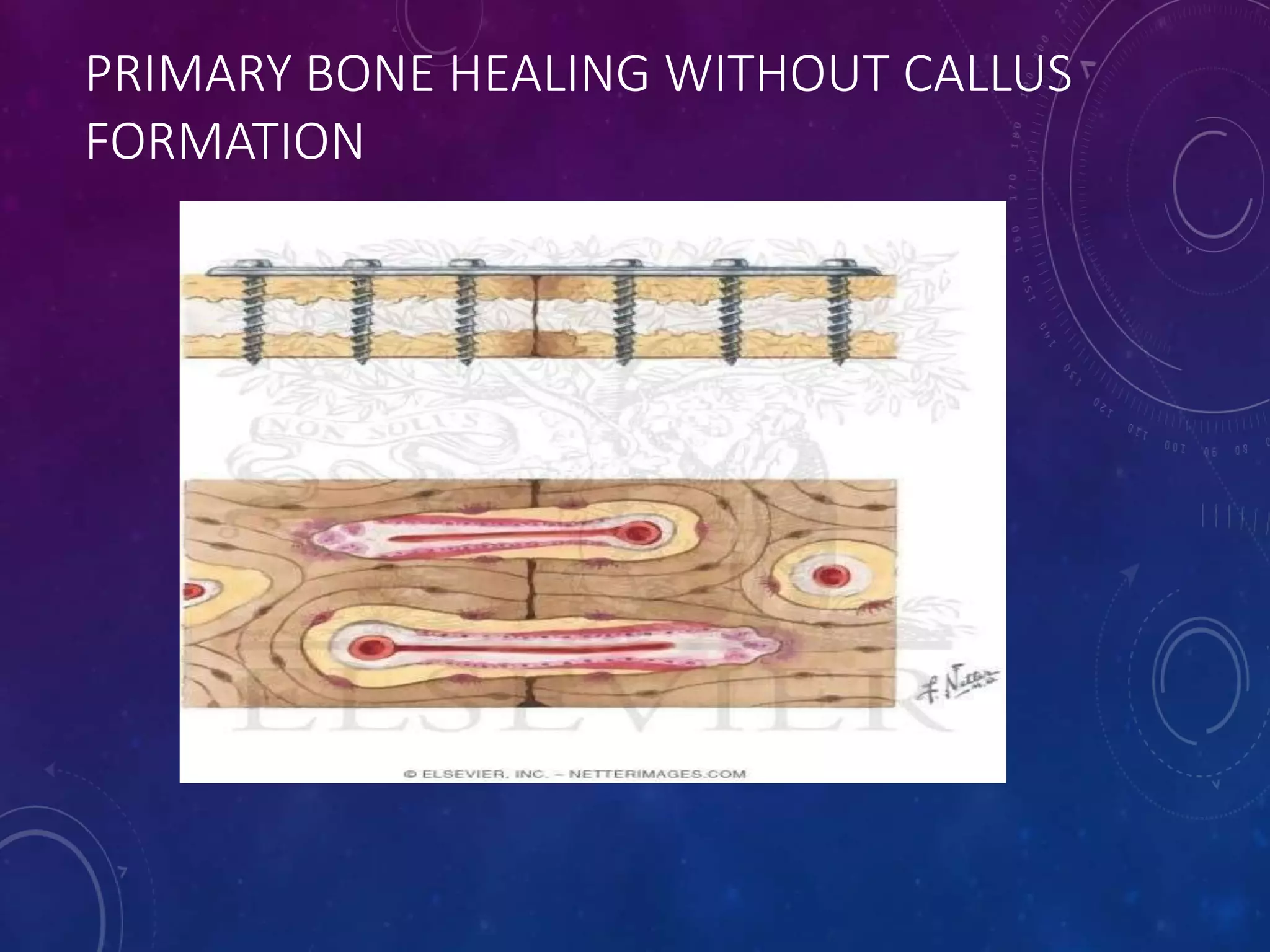 Fracture healing | PPTX