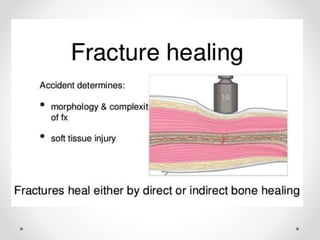 Bone biology and principle of bone healing. | PPT