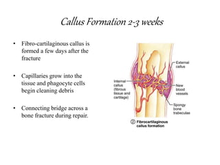 Fracture healing | PPTX