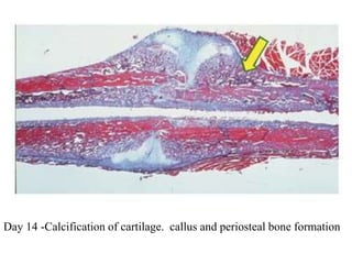 Fracture healing | PPTX