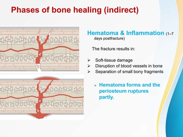 Fracture Healing.pptx