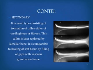 Fracture Healing.pptx
